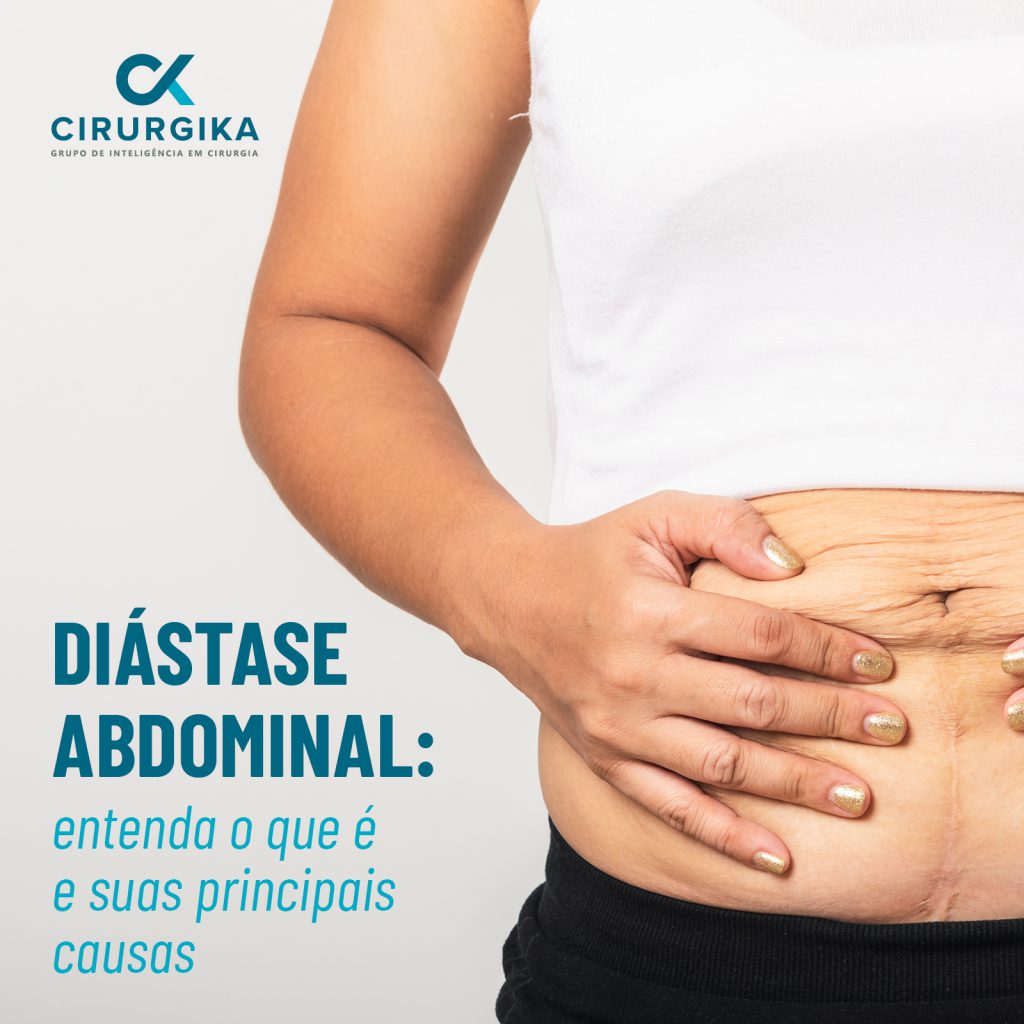 Diástase abdominal: entenda o que é e suas principais causas - Clínica ...