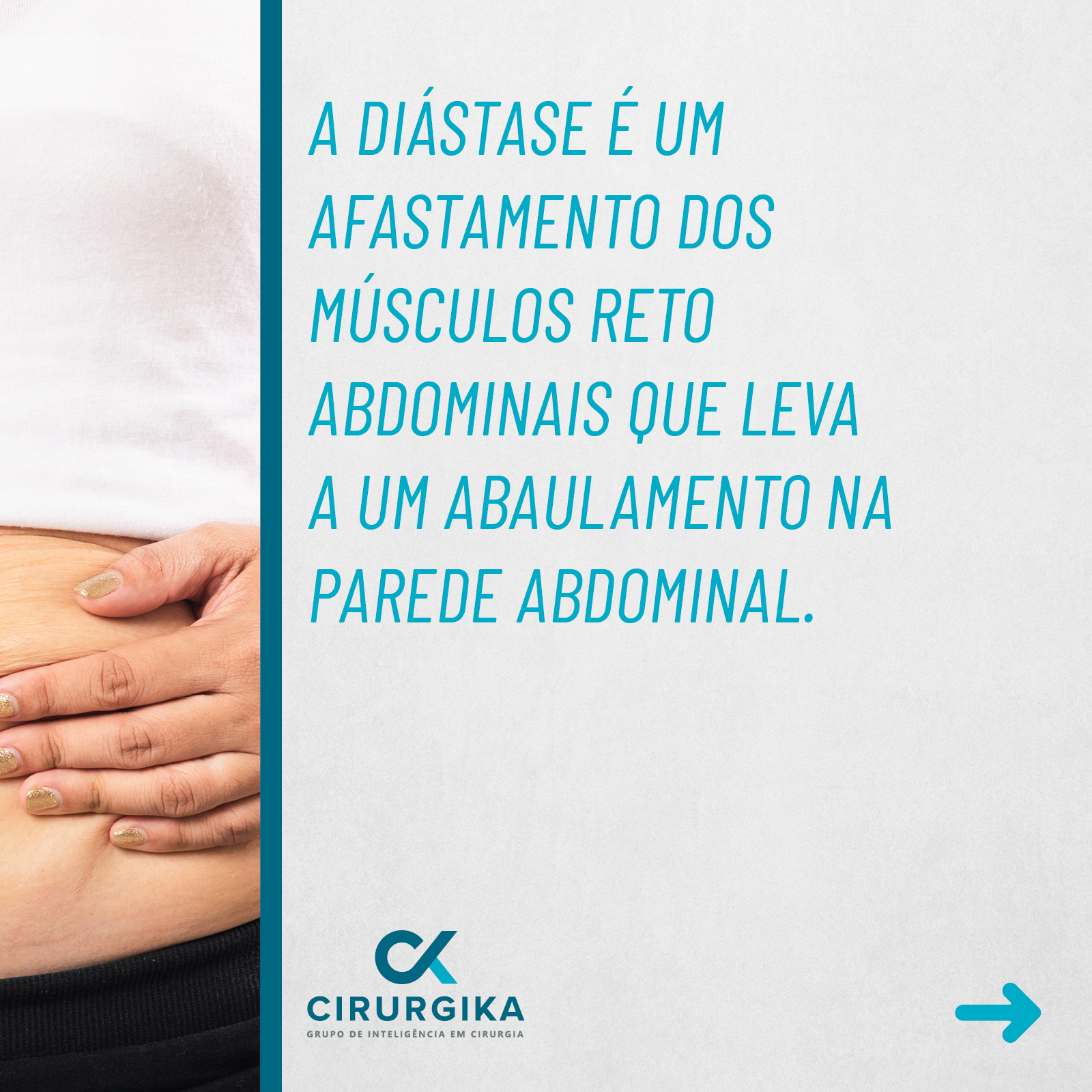 Diástase abdominal: entenda o que é e suas principais causas - Clínica ...